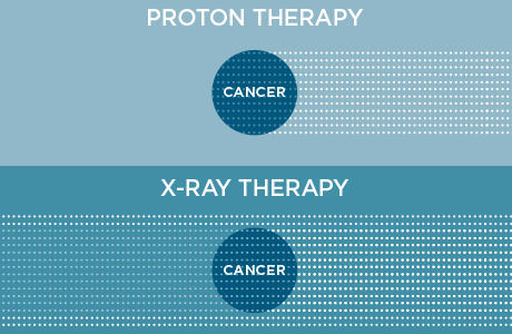 How Does Proton Therapy Work? | Northwestern Medicine Proton Center